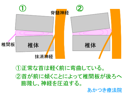 首の痛みが出る動きをセルフチェック｜あかつき療法院